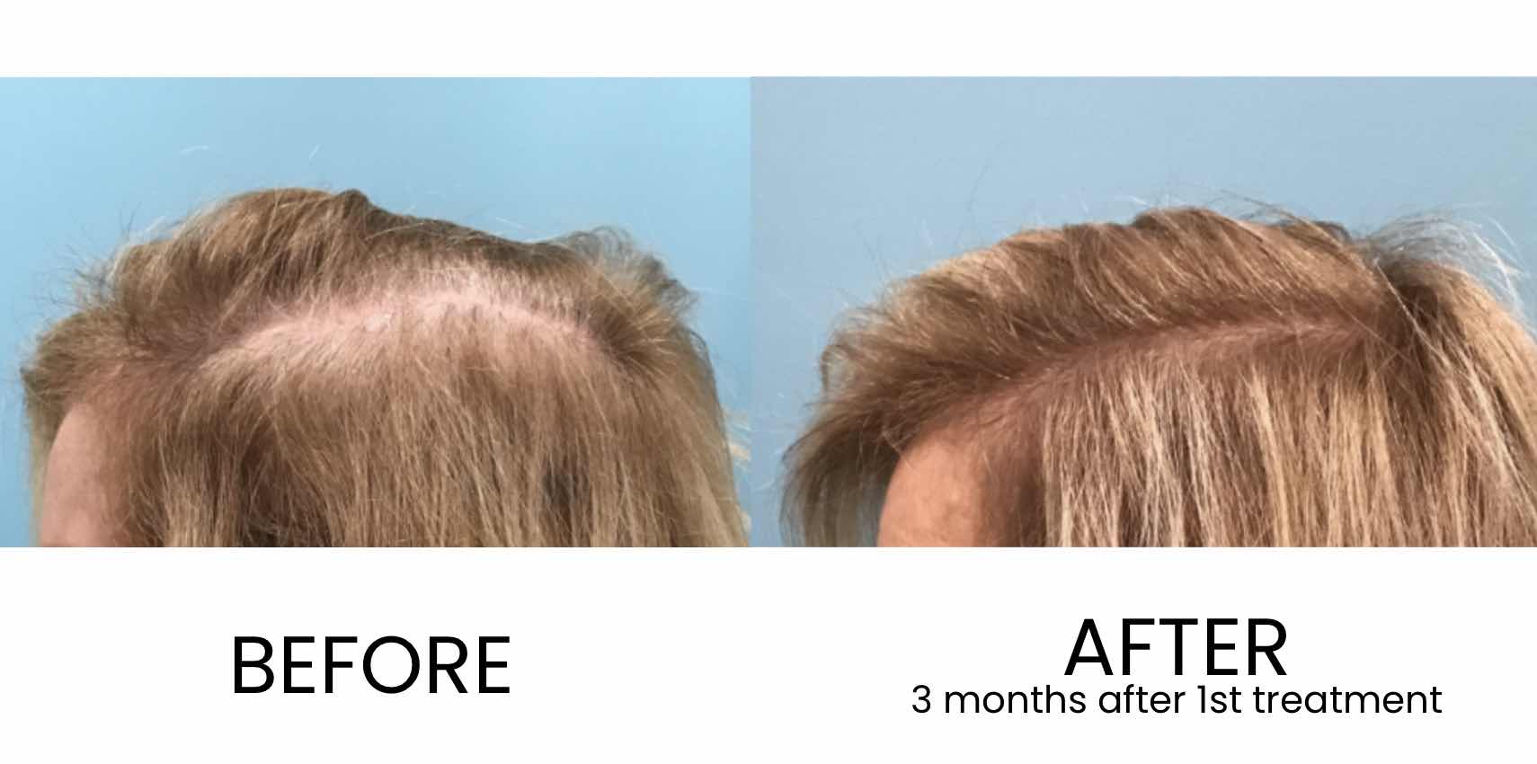 Exosomes for Hair Loss Fayetteville Northwest Arkansas AR
