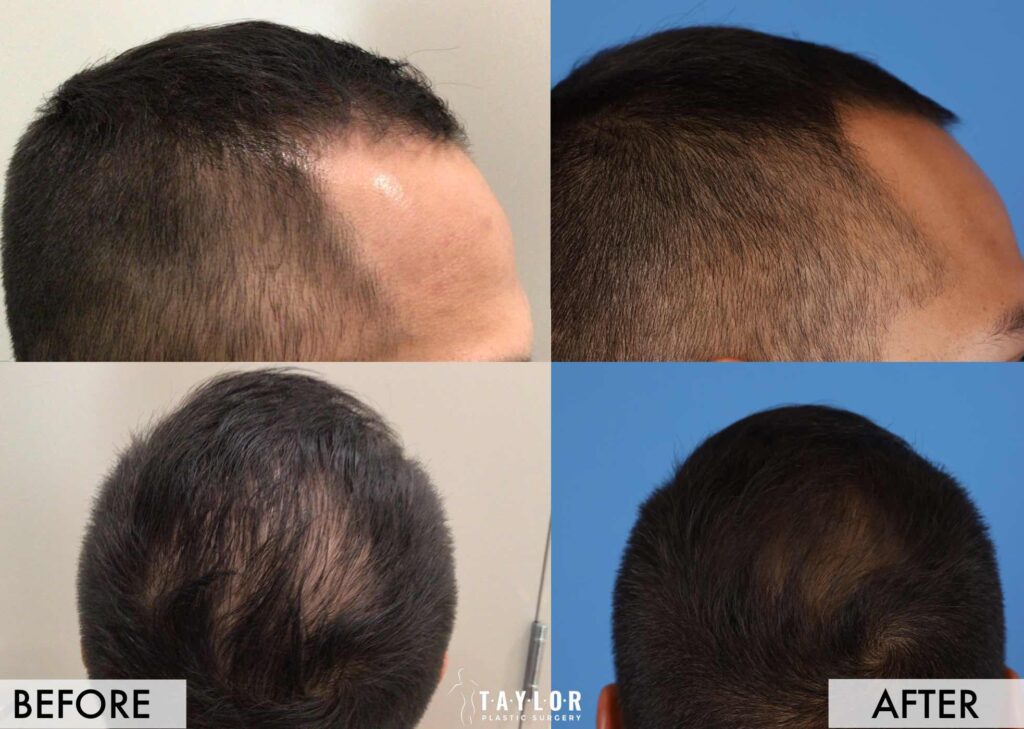 Exosomes for Hair Loss Fayetteville Northwest Arkansas AR