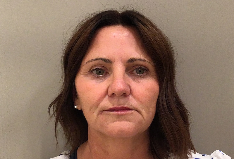 Patient #4442 - Taylor Plastic Surgery