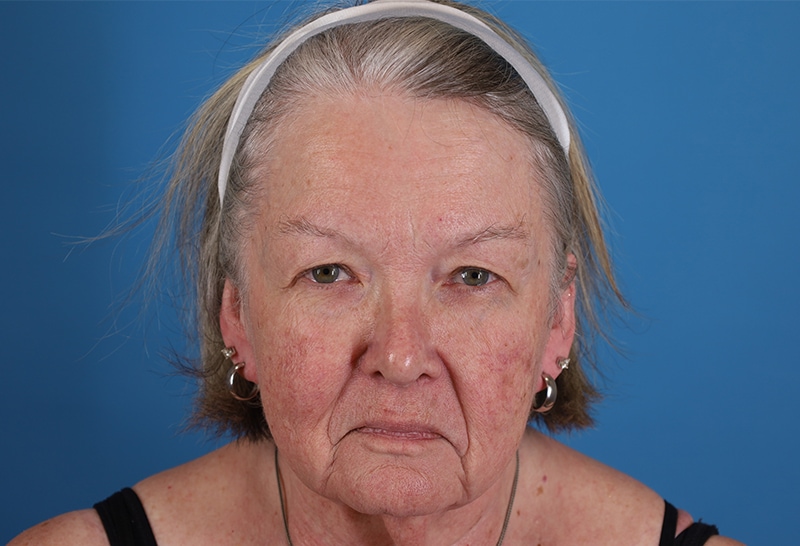 Injectables - Taylor Plastic Surgery